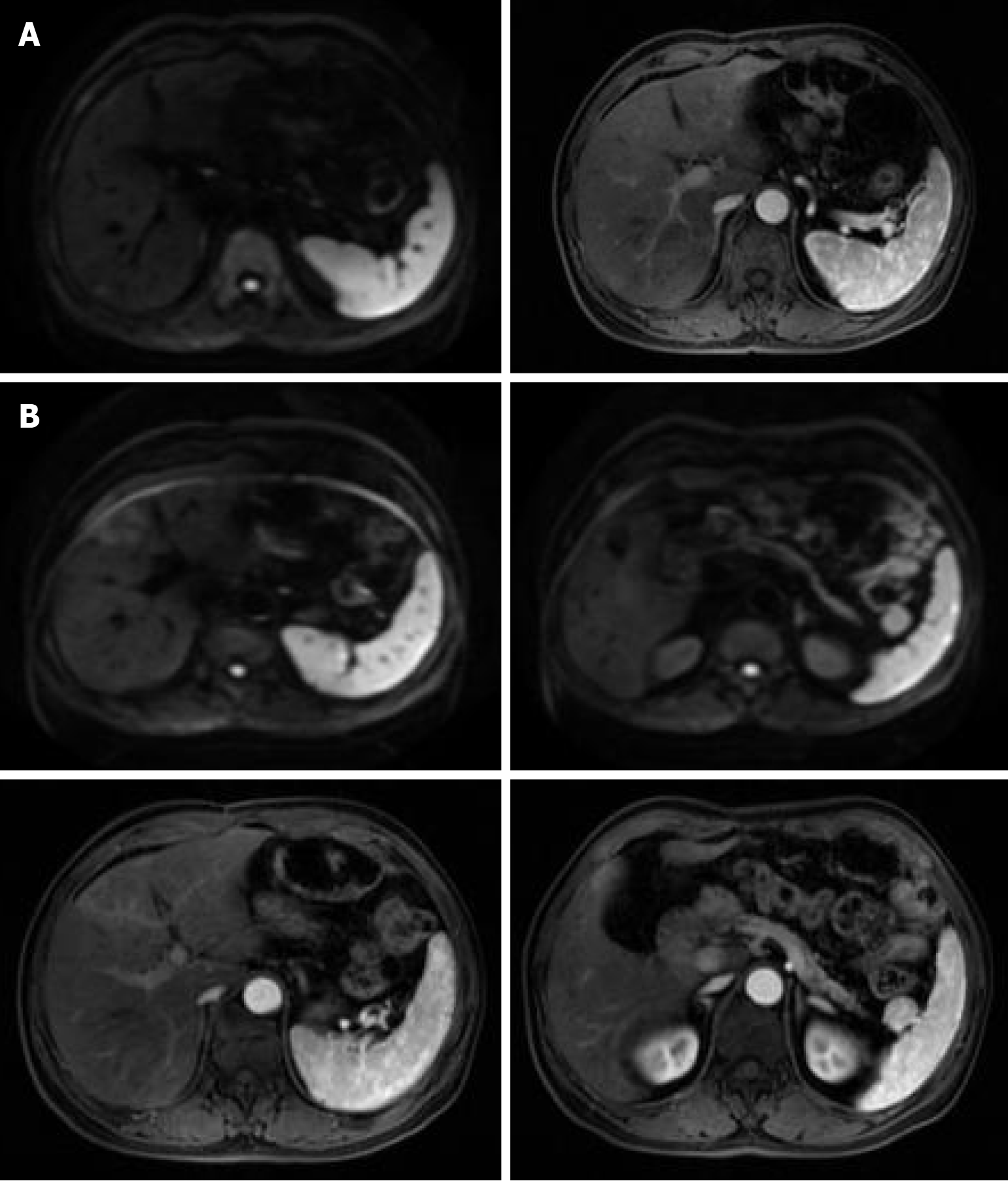 Radiofrequency ablation of liver metastases in a patient with pancreatic cancer and long-term ...