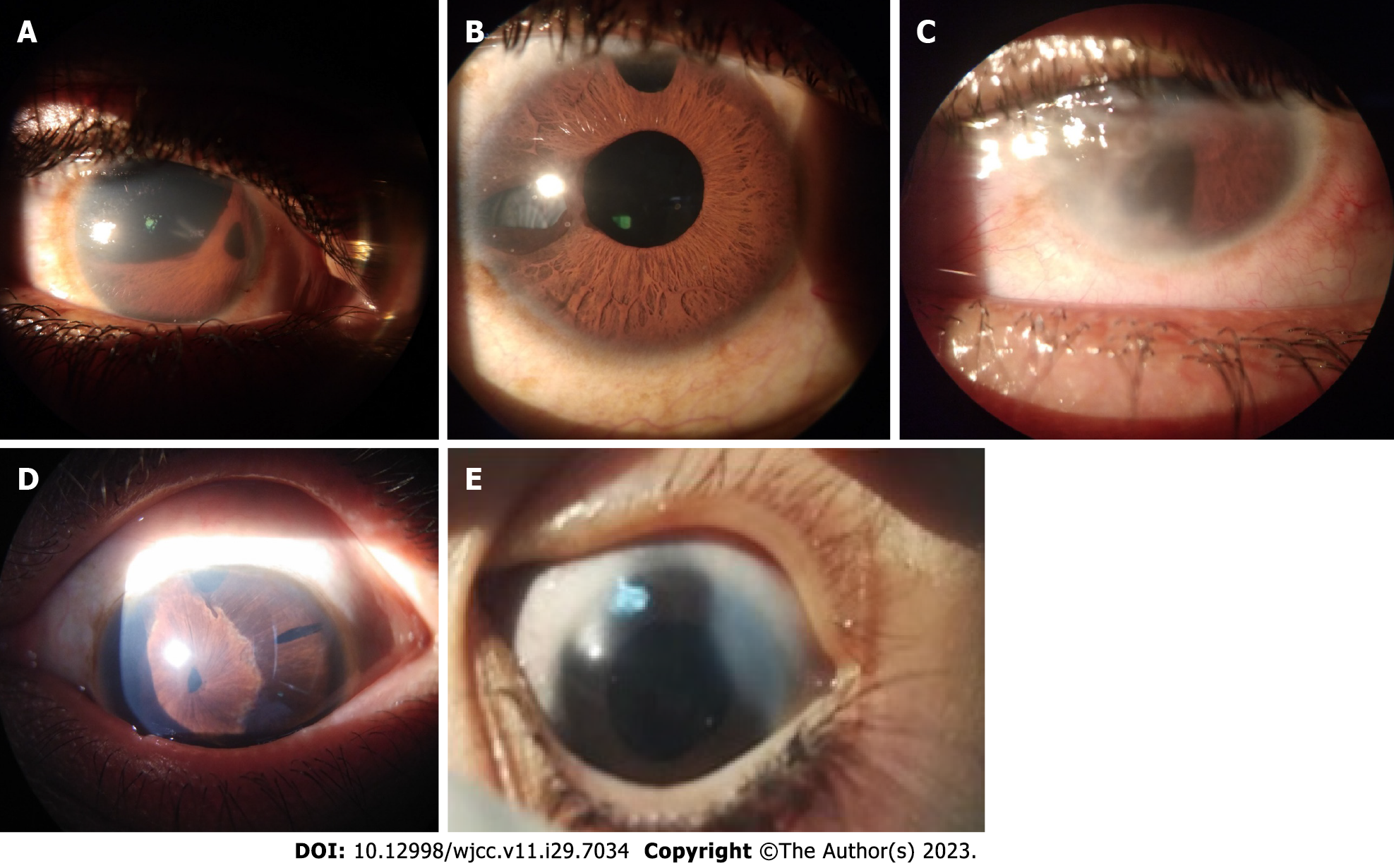 Axenfeld-Reiger syndrome: A search for the missing links