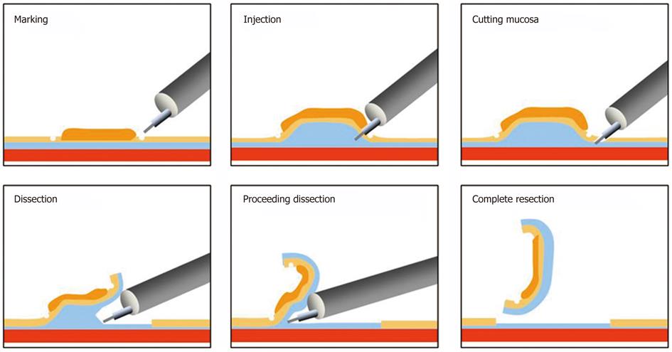  ESD Colon Endoscopic Incision Submucosal Dissection