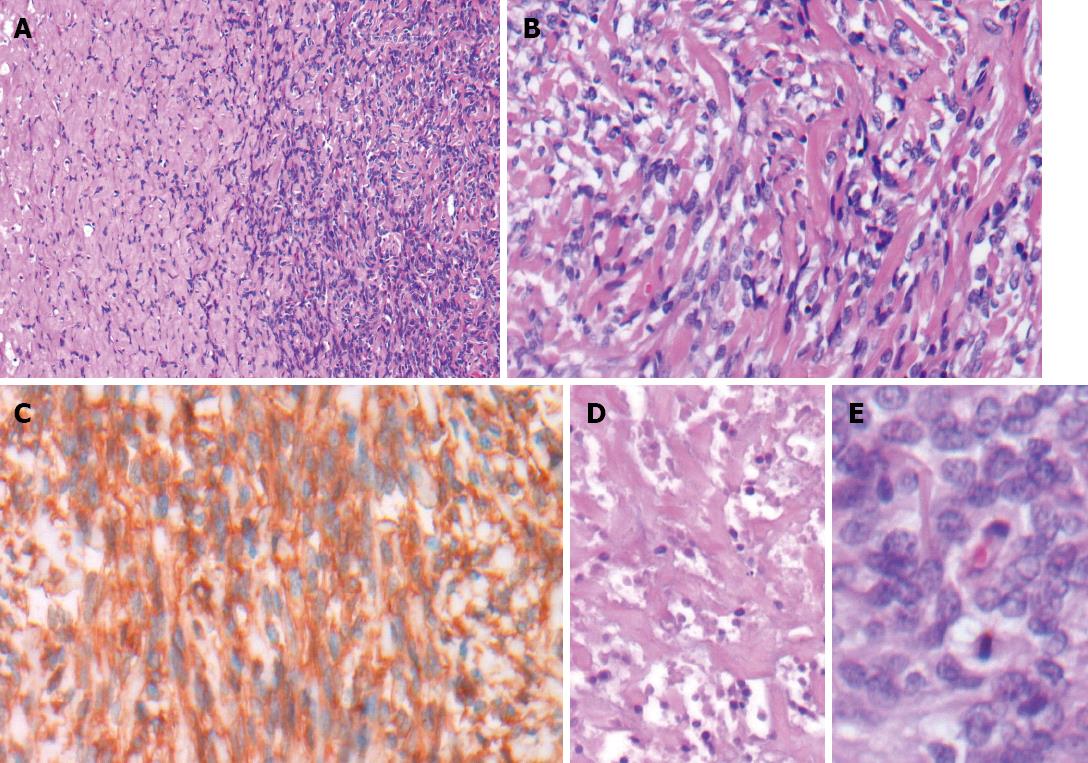 Malignant Solitary Fibrous Tumor Involving The Liver Malignant Solitary Fibrous Tumor Involving The Liver