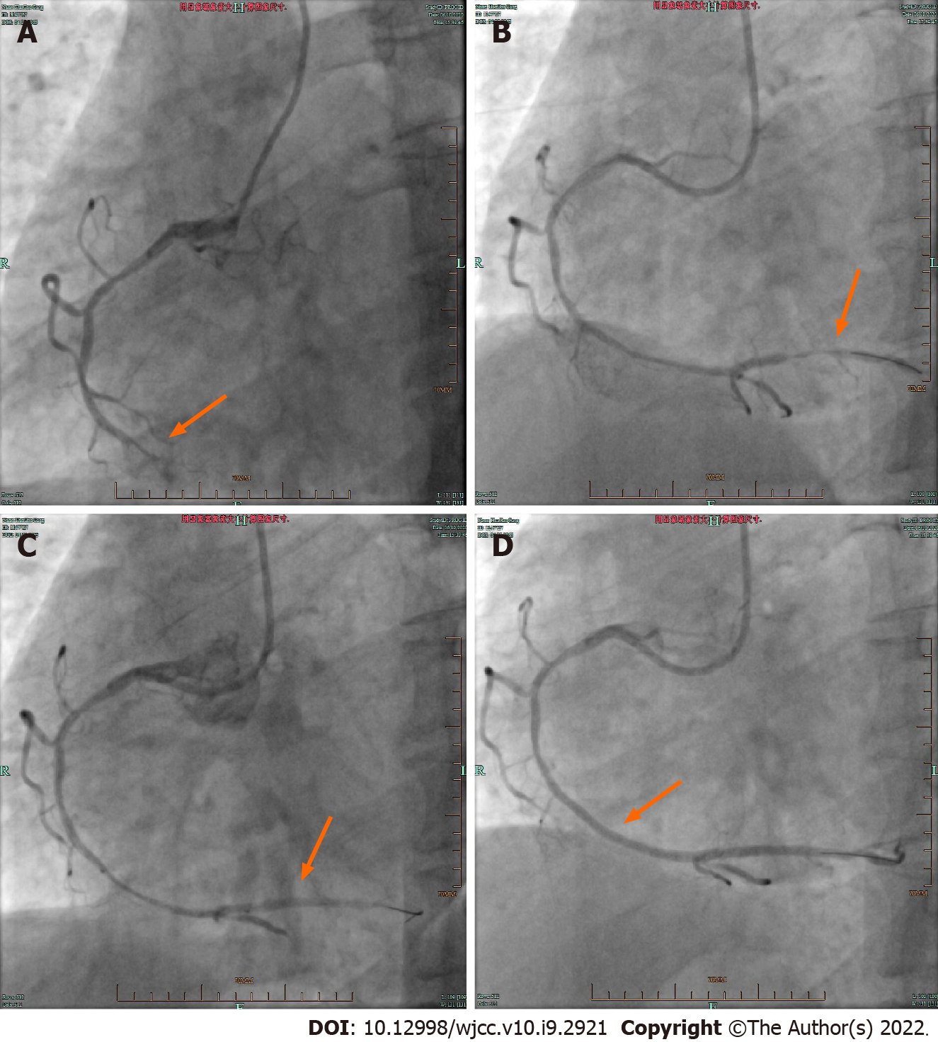 Acute coronary artery stent thrombosis caused by a spasm: A case report