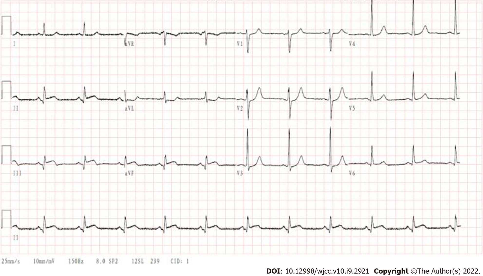 Acute coronary artery stent thrombosis caused by a spasm: A case report