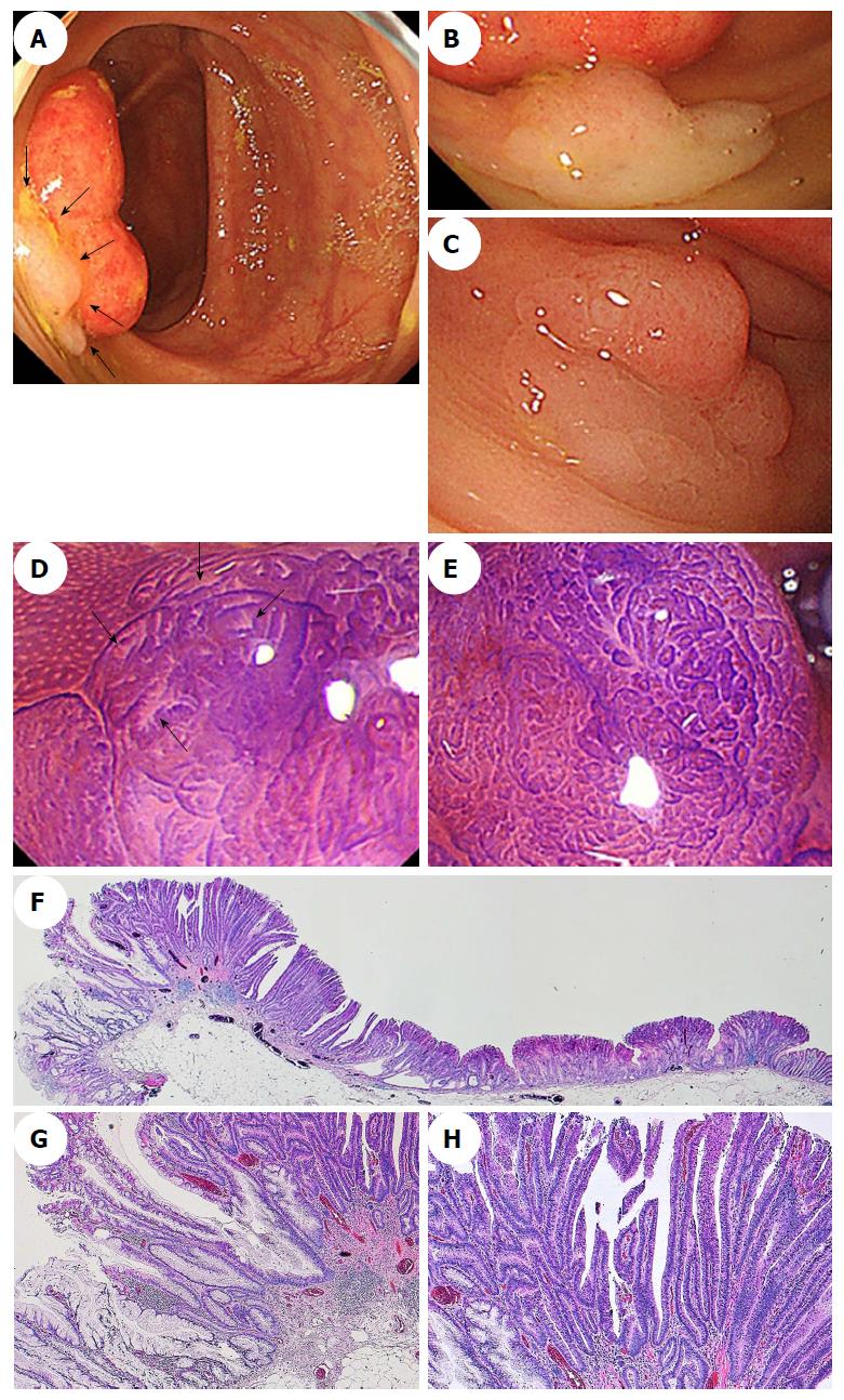 Ascending Colon Polyp Tubular Adenoma Margucciodesign Ascending Colon Polyp Tubular Adenoma Margucciodesign