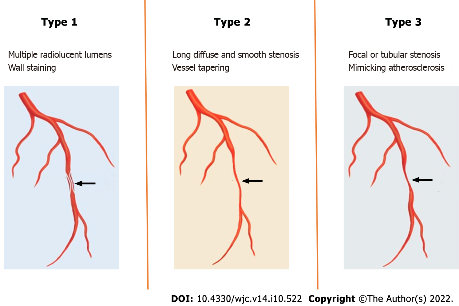 What Is Dissection Of An Artery At Ella Gatliff Blog What Is Dissection Of An Artery At Ella Gatliff Blog