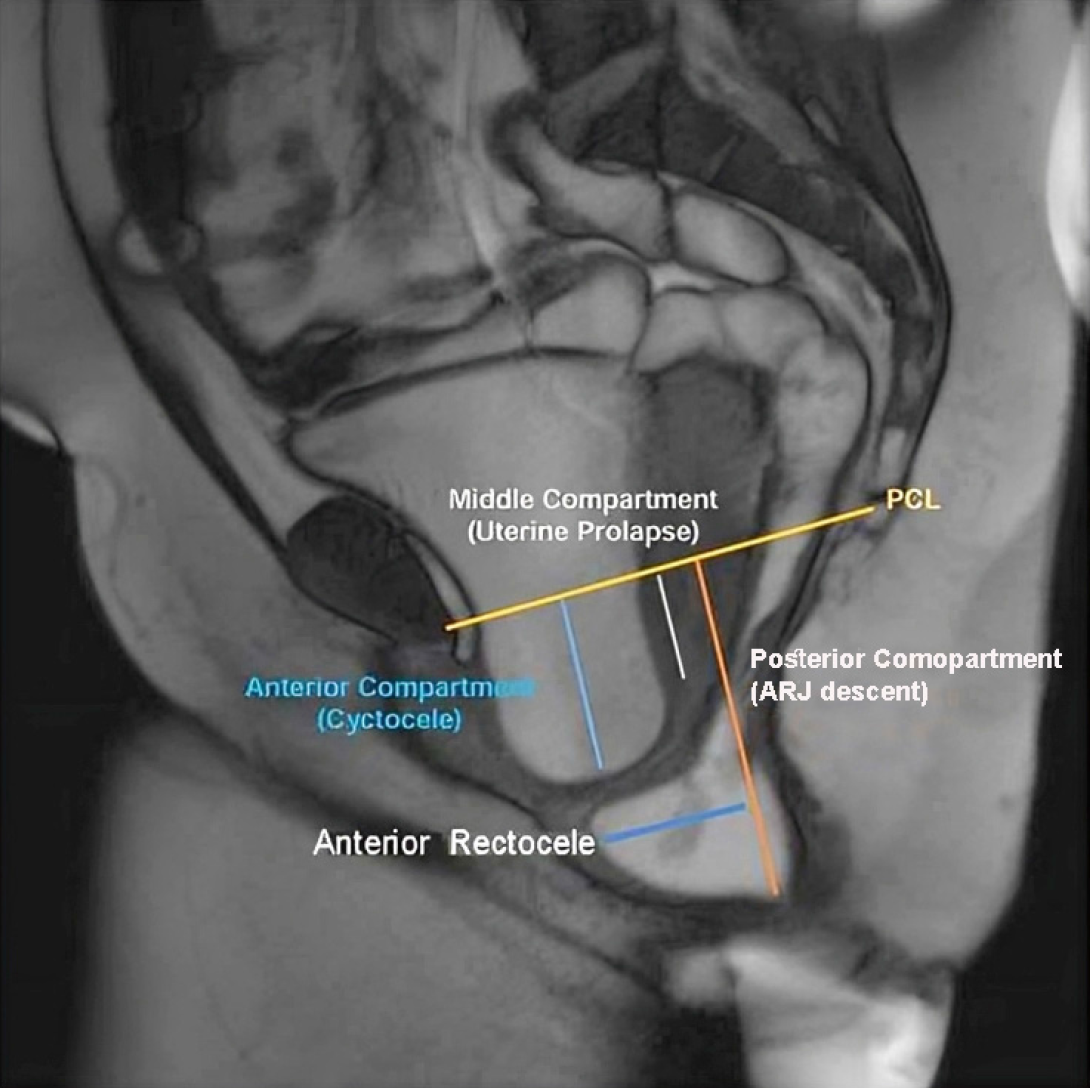 Magnetic resonance defecography assessment of obstructed defecation ...
