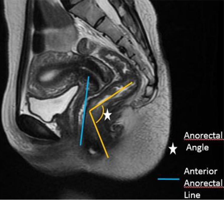 Magnetic resonance defecography assessment of obstructed defecation ...
