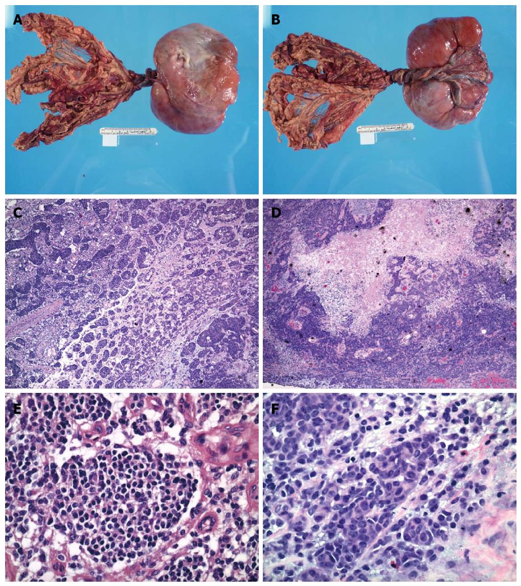 Desmoplastic Small Round Cell Tumor With Atypical Immunohistochemical