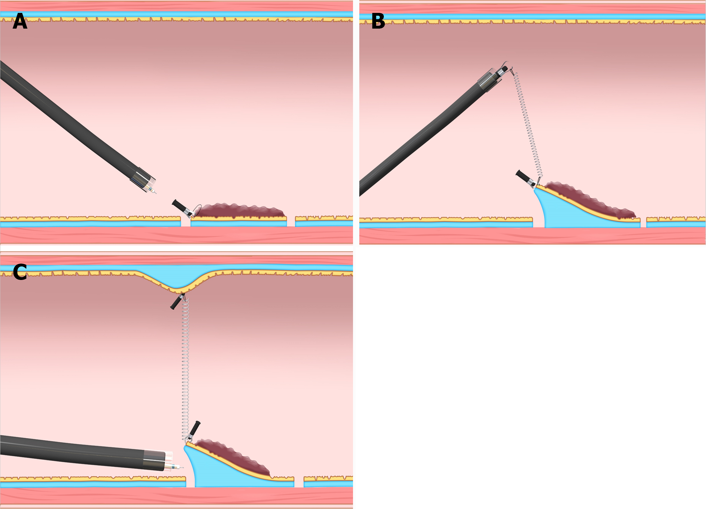 Device-assisted traction methods in colorectal endoscopic submucosal dissection and options for ...