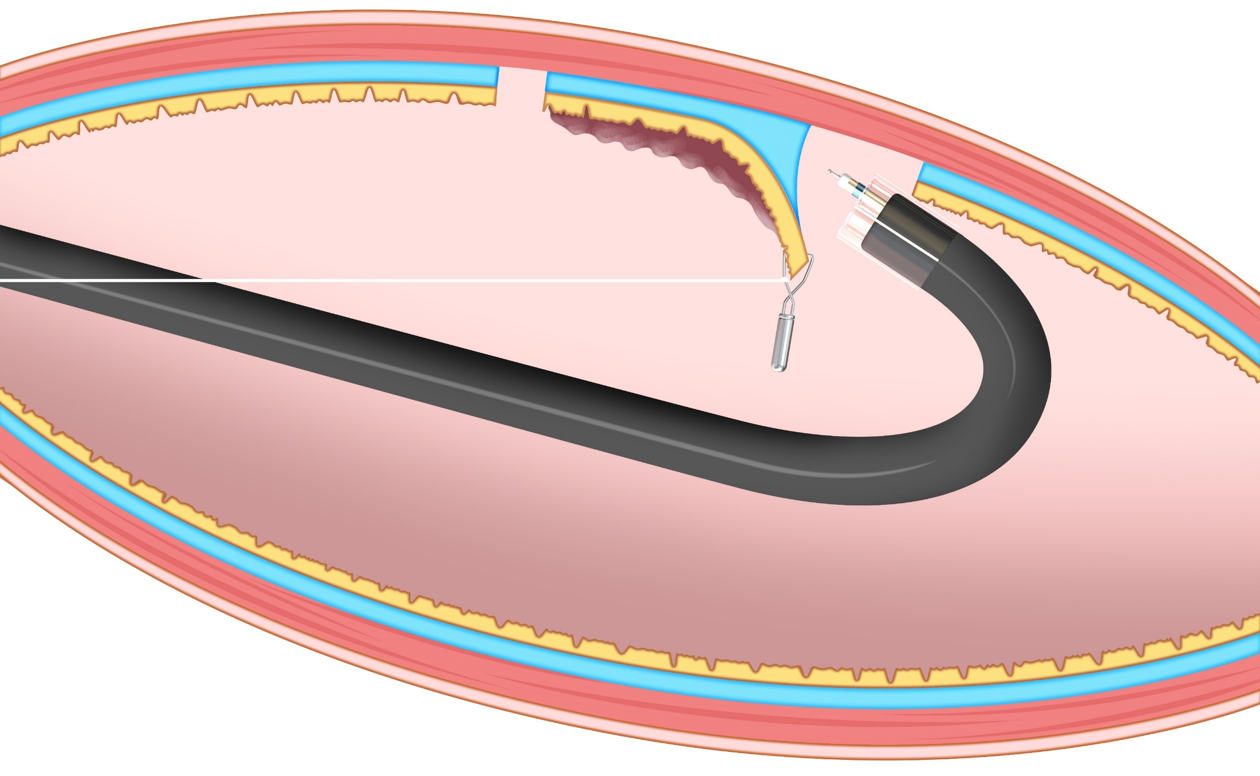 Device-assisted traction methods in colorectal endoscopic submucosal ...