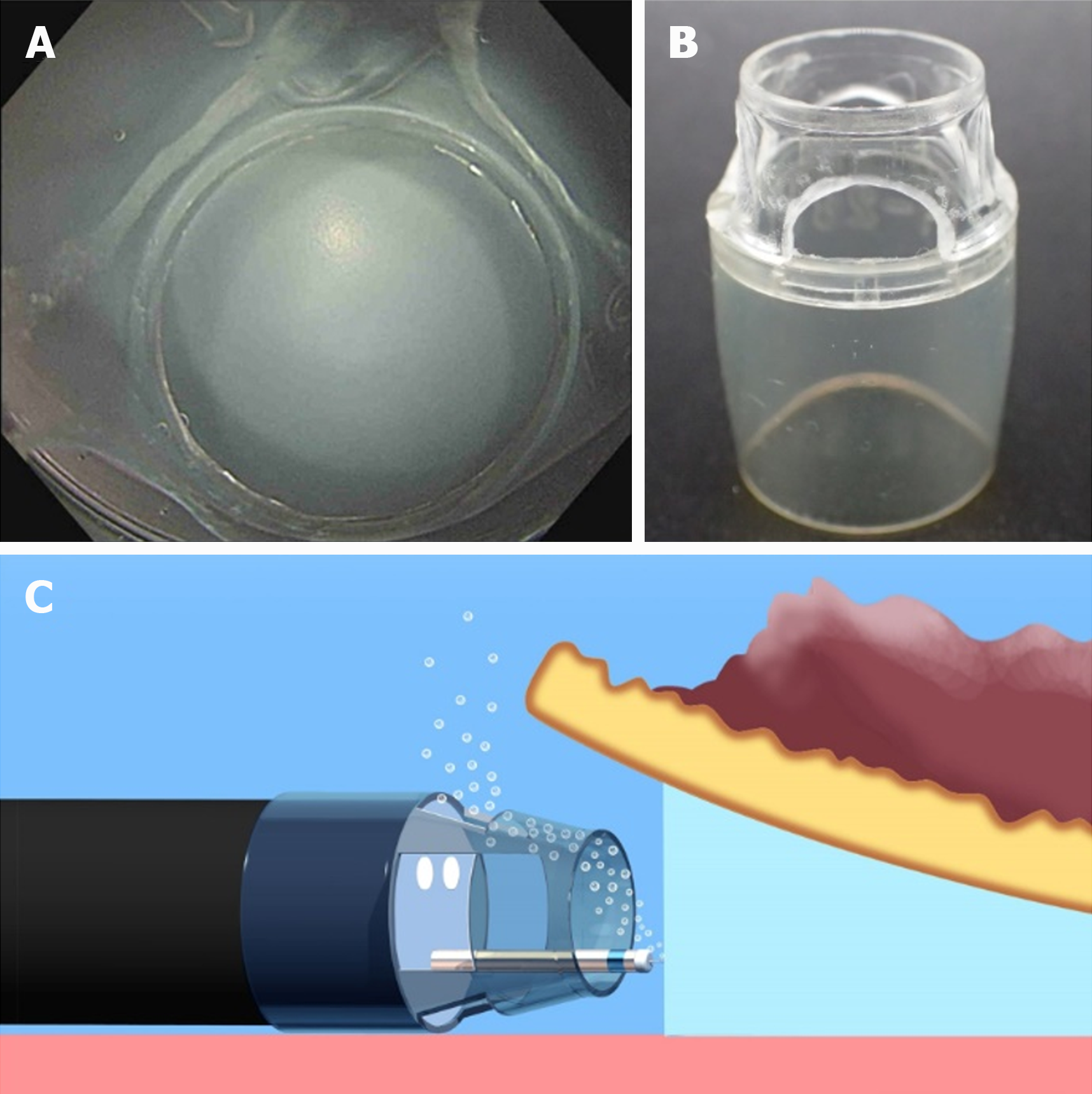 Device-assisted traction methods in colorectal endoscopic submucosal ...