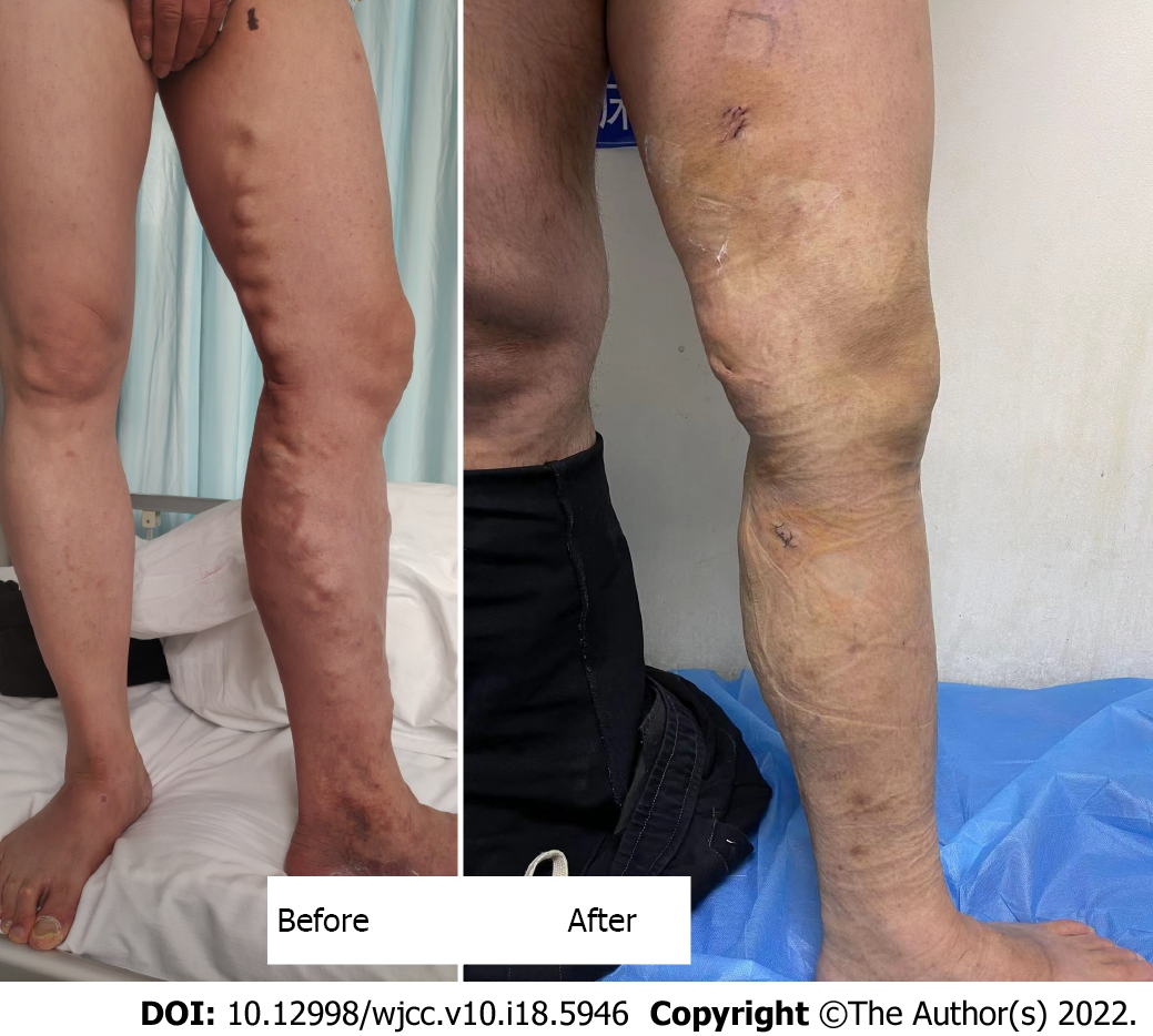 Complications And Failure Of Endovenous Laser Ablation And 54 OFF Complications And Failure Of Endovenous Laser Ablation And 54 OFF