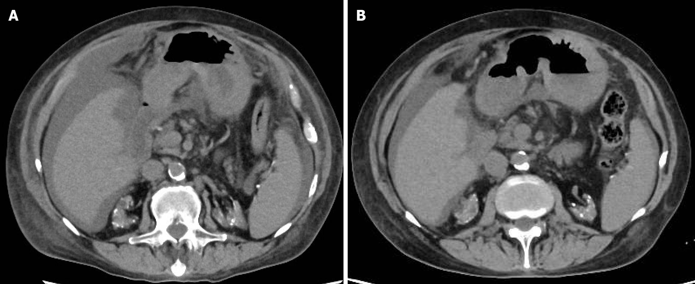 Spontaneous bacterial peritonitis due to Edwardsiella tarda in an ...