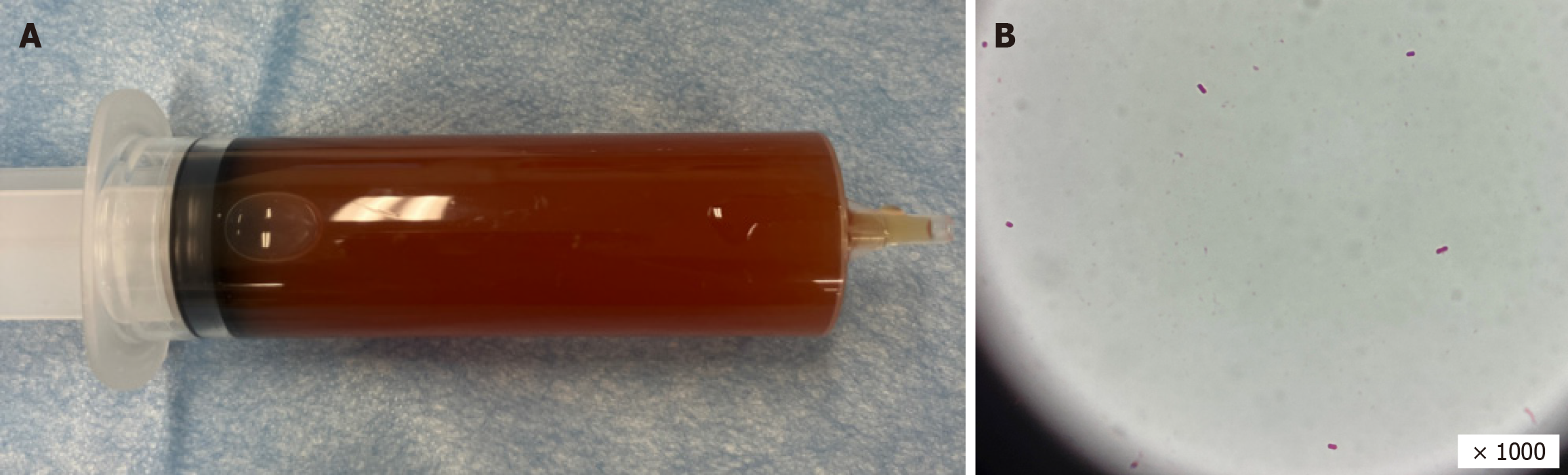 Spontaneous bacterial peritonitis due to Edwardsiella tarda in an ...