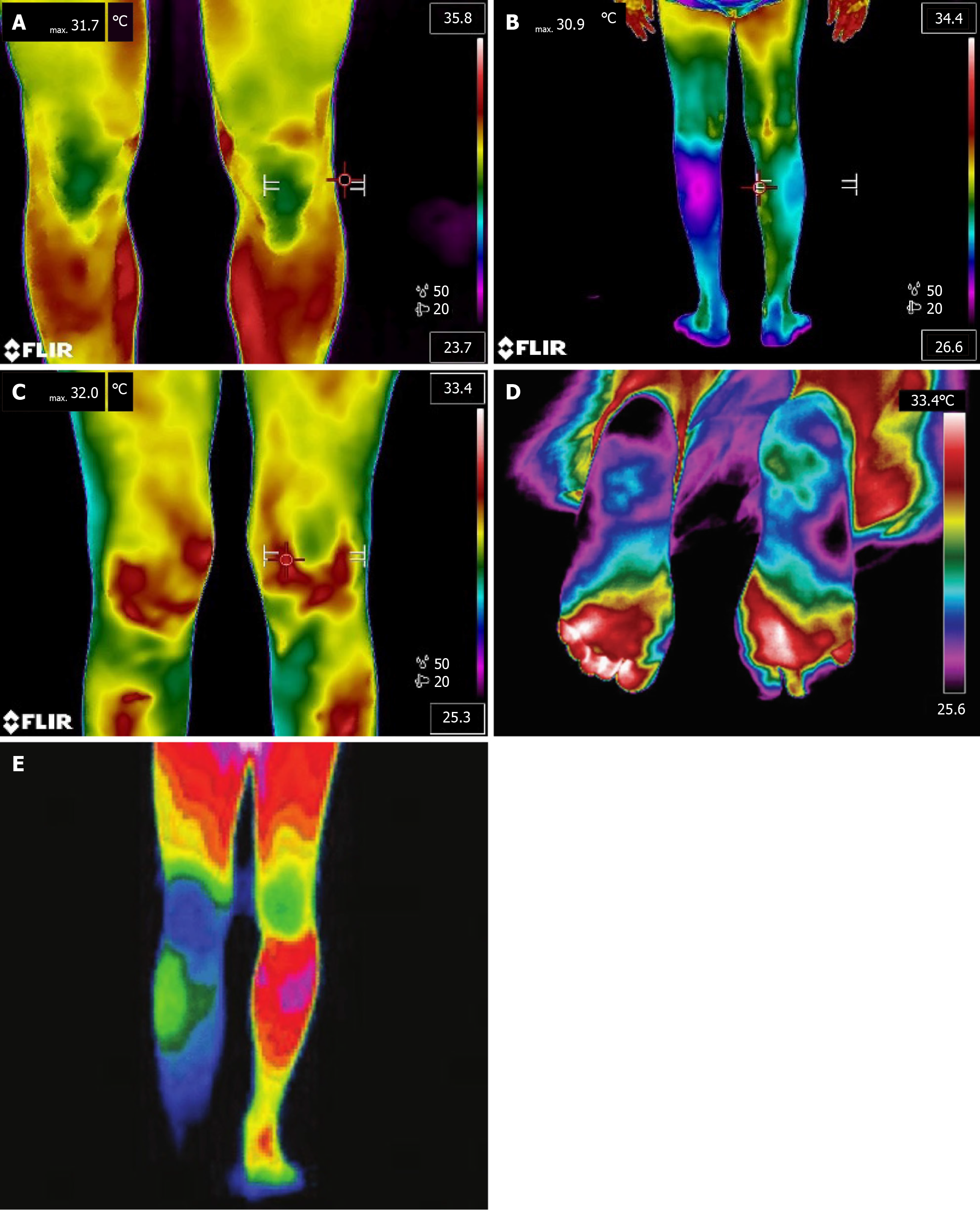 Science of heat mapping: Thermography in musculoskeletal disorders
