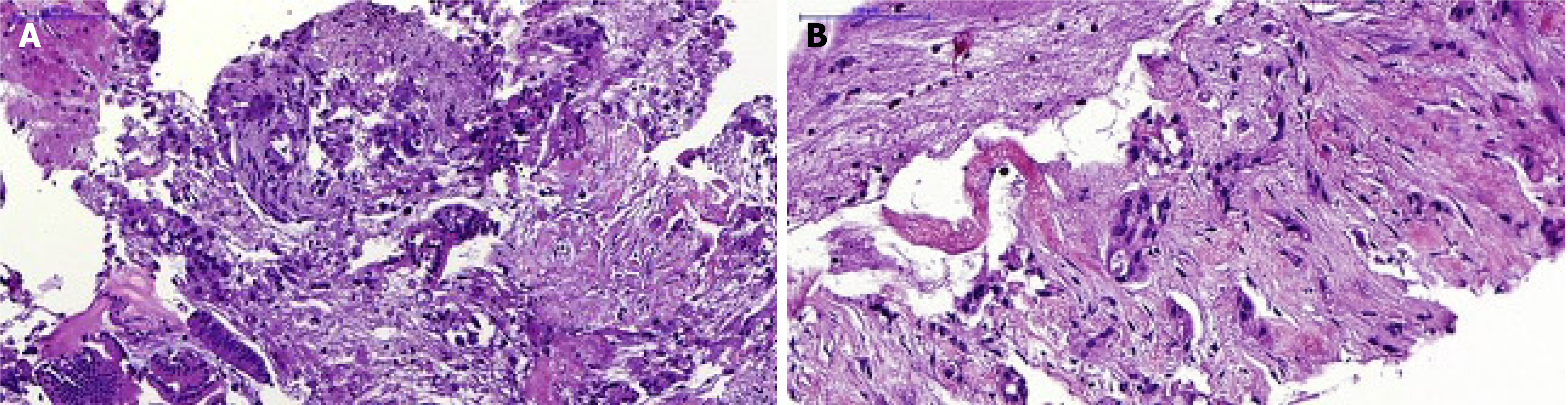 Prospective randomized study comparing Franseen 22-gauge vs standard 22 ...