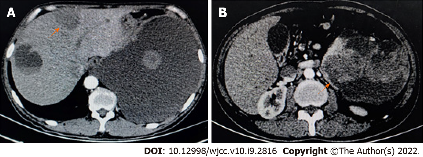 Treatment with sorafenib plus camrelizumab after splenectomy for ...