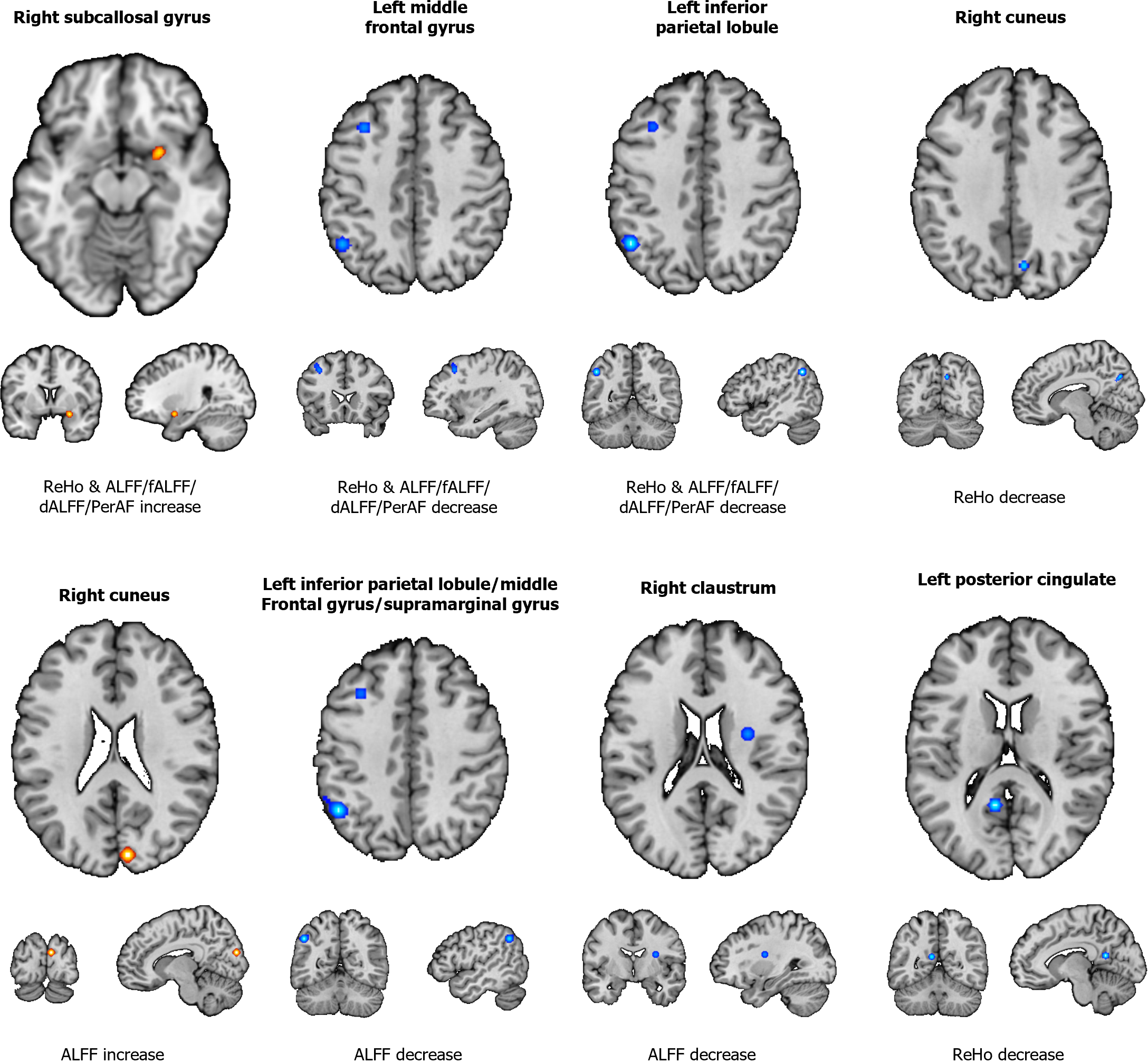 Alterations of sleep deprivation on brain function: A coordinate-based resting-state functional ...