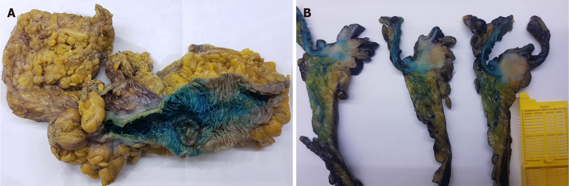 Colorectal cancer lymph node dissection and disease survival