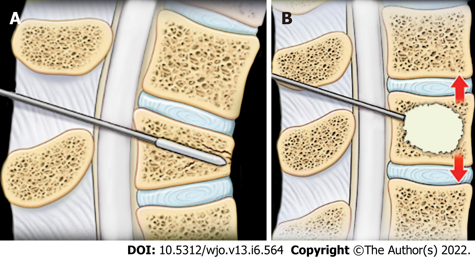 Managements of osteoporotic vertebral compression fractures: A ...